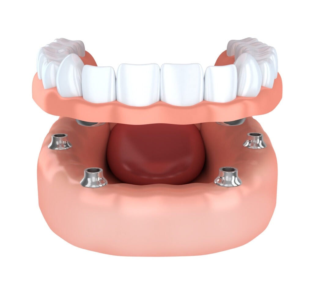 All About Dentures: A Comprehensive Guide
