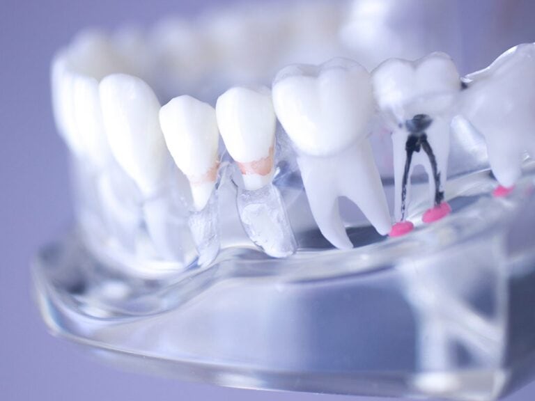 Root Canal in Hamilton, Ontario | Leading Root Canal Specialists in ...